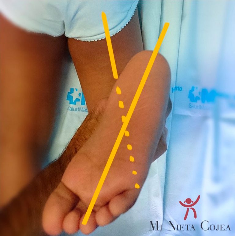 Torsión tibial interna – Mi Nieta Cojea