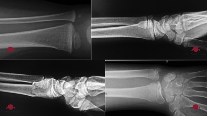 Rodete – Mi Nieta Cojea