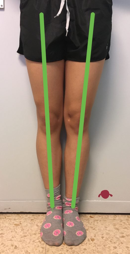 Piernas en X – mete las rodillas – genu valgo – Mi Nieta Cojea